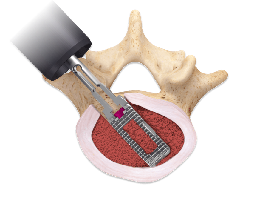 Elite Expandable - Spineology