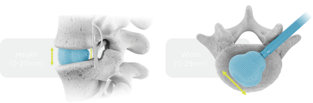 OptiMesh Align™ - Spineology