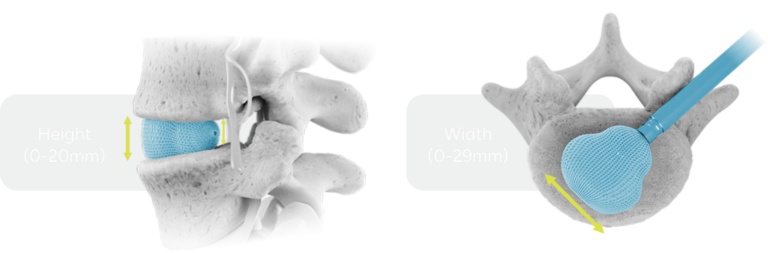 OptiMesh Align™ - Spineology