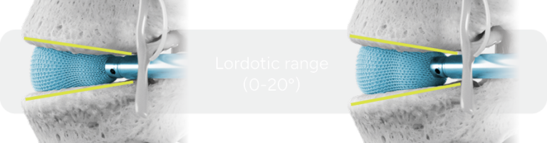 OptiMesh Align™ - Spineology